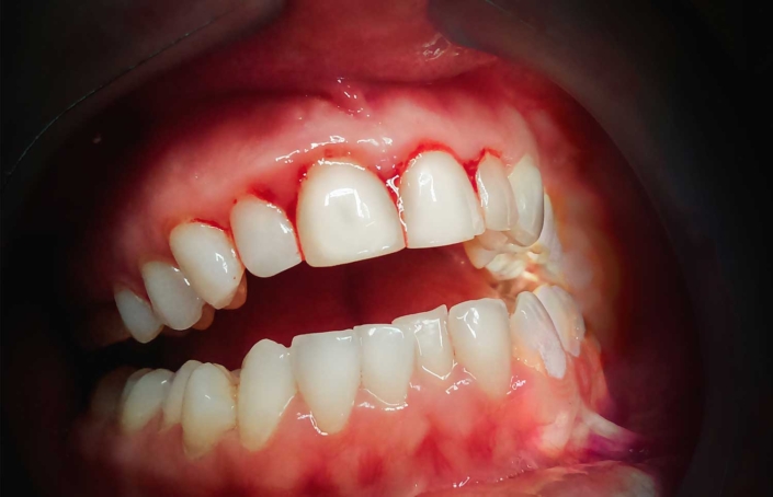 Periodontal (Gum) Treatment - Milano Dental Studio - NEW YORK