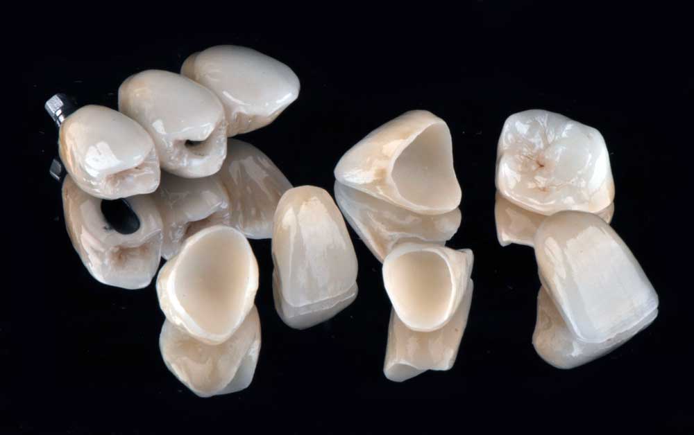 Before & after gallery - Milano Dental Studio - NEW YORK