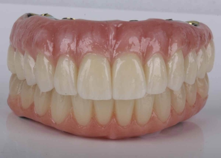 Choosing the Right Restorative Material for Your All-on-4 Prosthesis ...