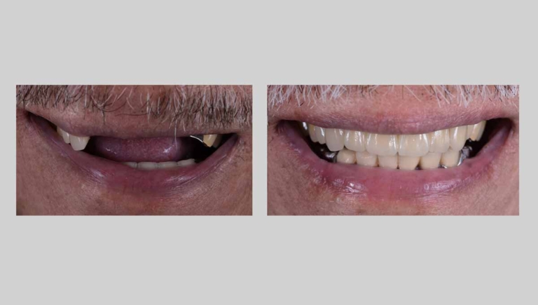 How to Maintain for Your Immediate All-on-4 Prosthesis - Milano Dental ...